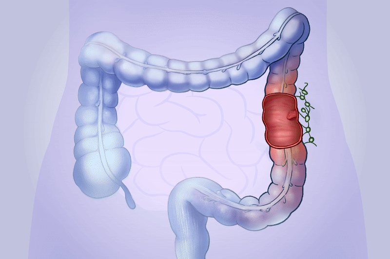 Cáncer de colon: Primeros signos