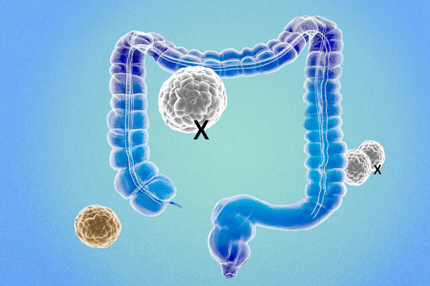 Estudio revela cuándo se considera curado el cáncer de colon